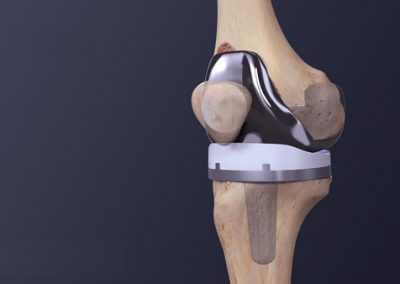 Robotics & Smart Knee Replacement | Dundon Orthopedics and Sports Medicine